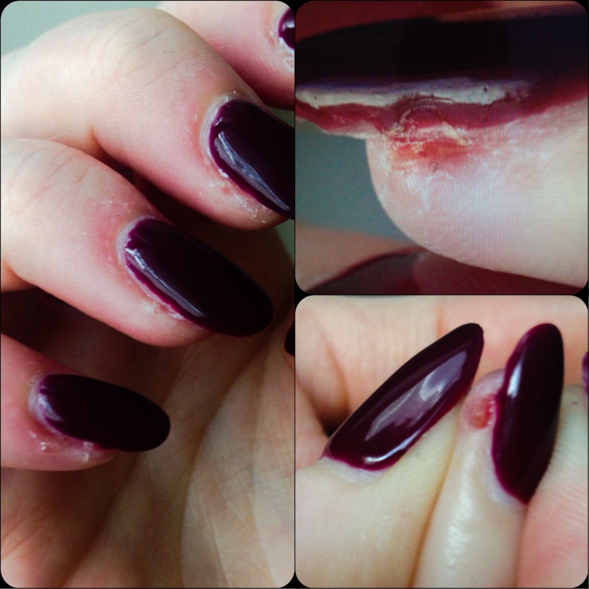 When manicures turn dangerous: Allergic reactions and the importance of ...