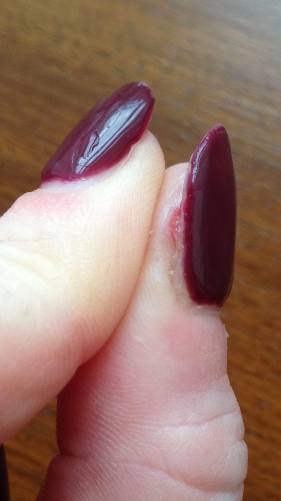 When manicures turn dangerous: Allergic reactions and the importance of ...