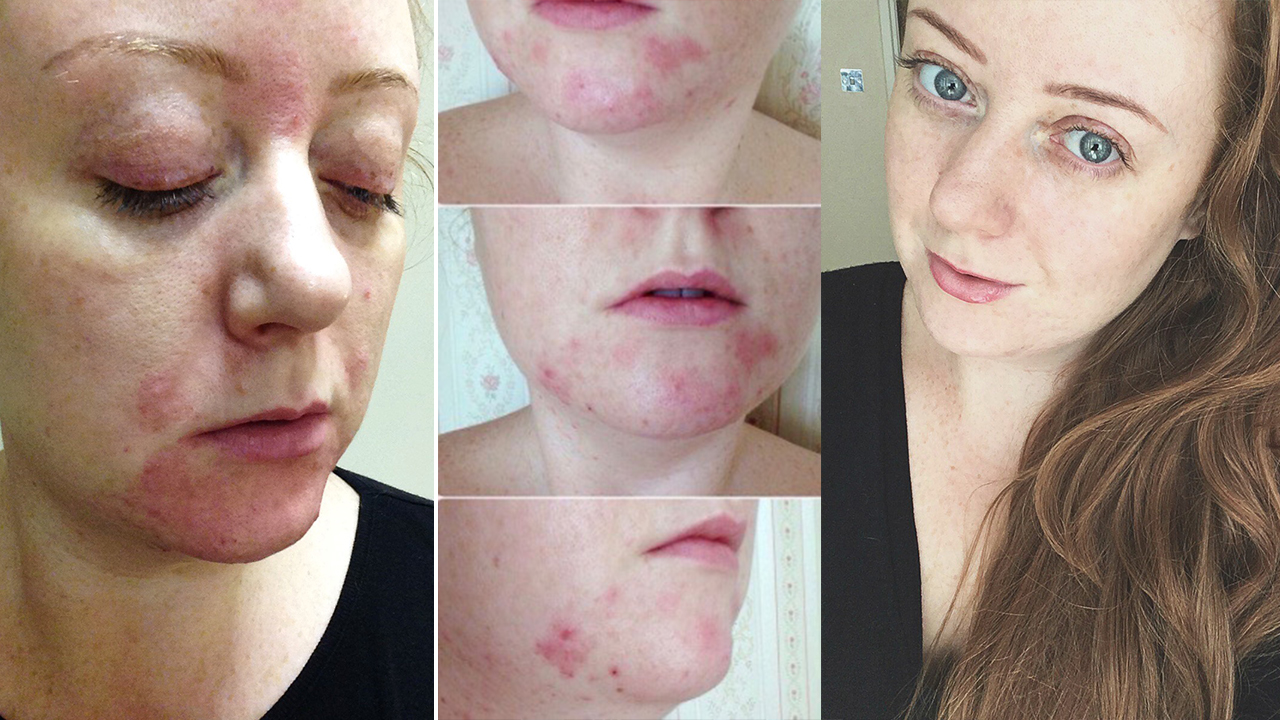 How I'm keeping my acne under control with Thuja: Before and After ...