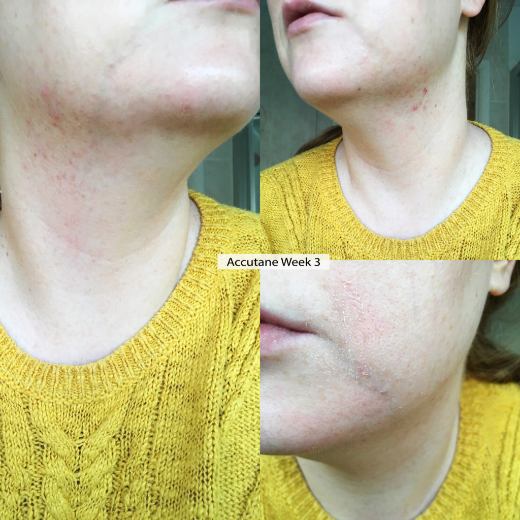 My Accutane Journey: Week 3 | Accutane the miracle worker - Rachael Divers